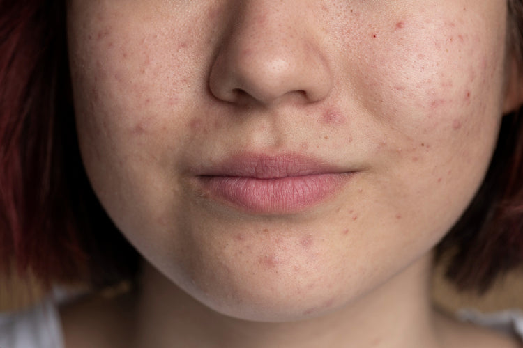 Period Acne: The Ultimate Guide to Hormonal Breakouts – The Nature's Store